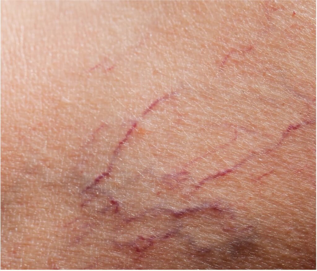 Discover Flawless Skin with SharpLight’s Long Pulse Laser at Newbody NL ...