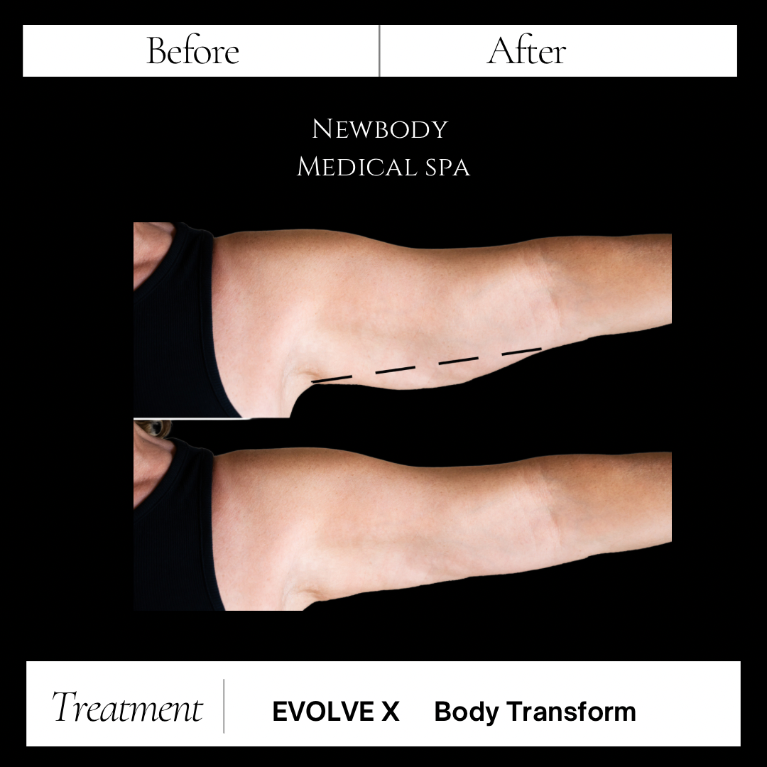 Evolve X By InMode - NEWBODY NL